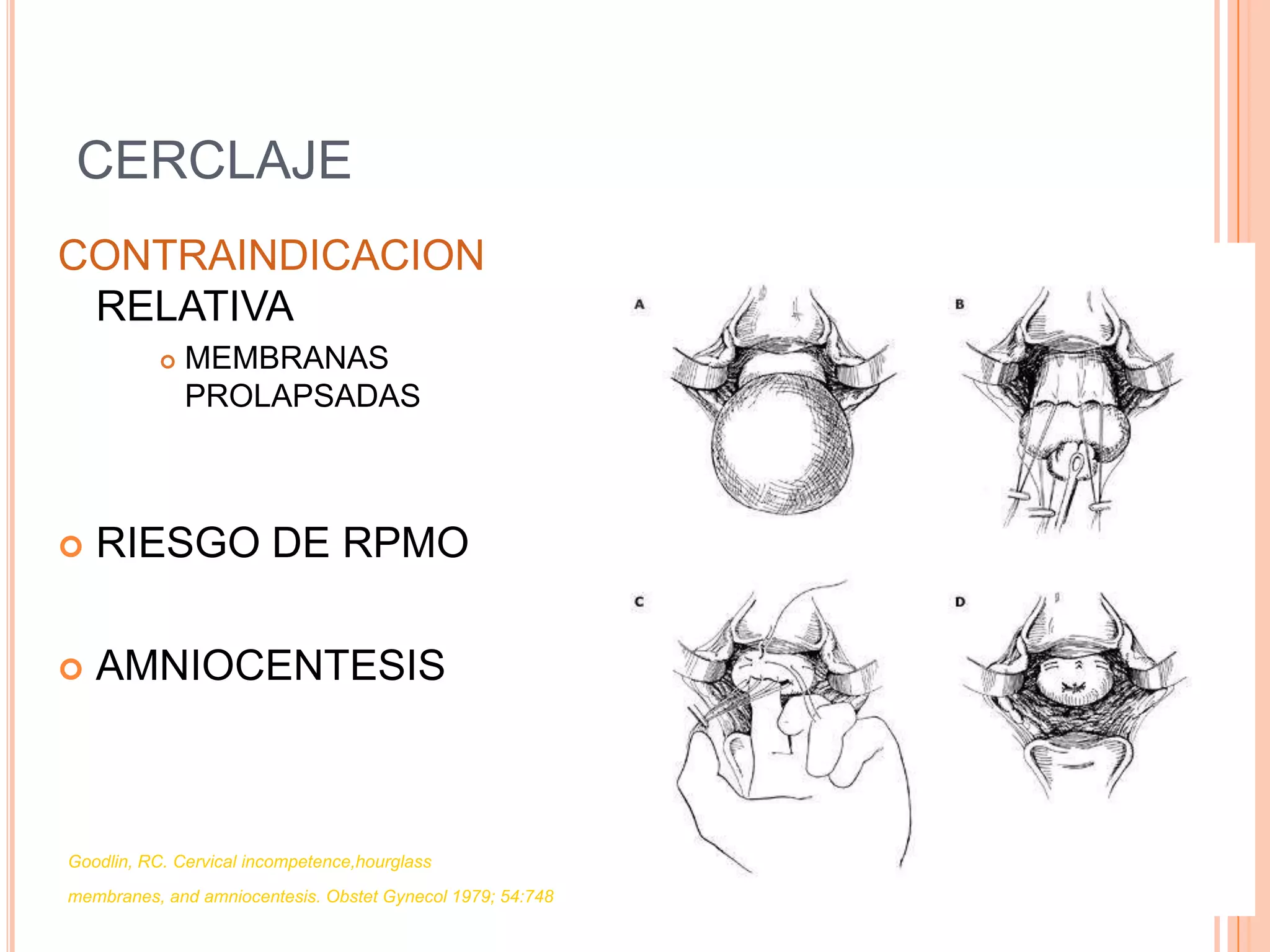 cerclaje cervical, igss agoto 2013 | PPTX
