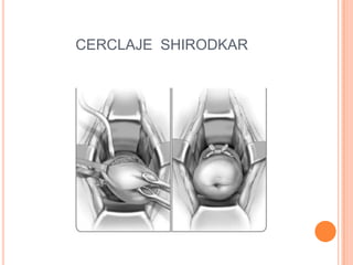cerclaje cervical, igss agoto 2013 | PPTX