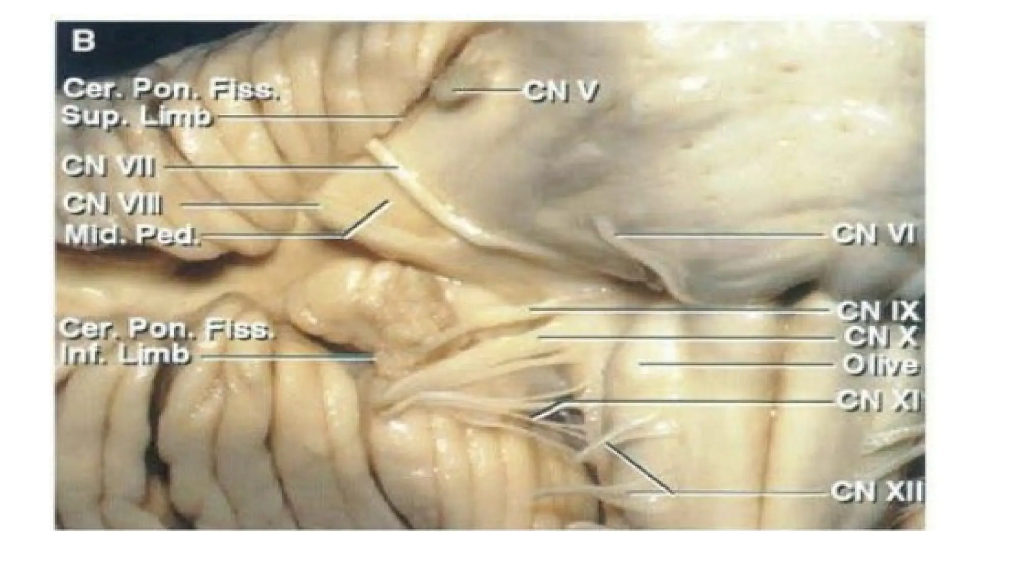 cerebellar anatomy and physiology mictrosurgical anatomy and approches ...