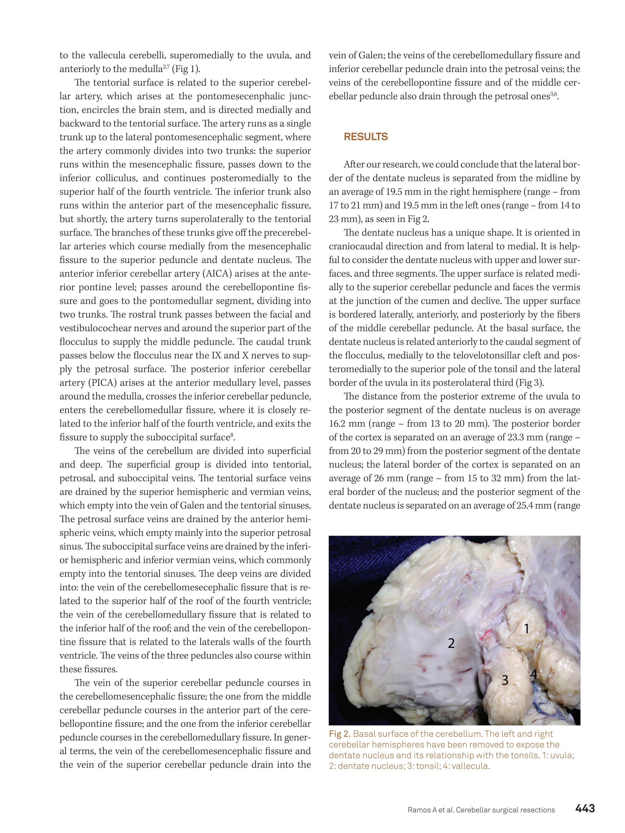 Cerebellar anatomy as applied to cerebellar microsurgical resections | PDF
