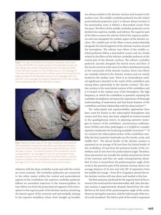 Cerebellar anatomy as applied to cerebellar microsurgical resections | PDF