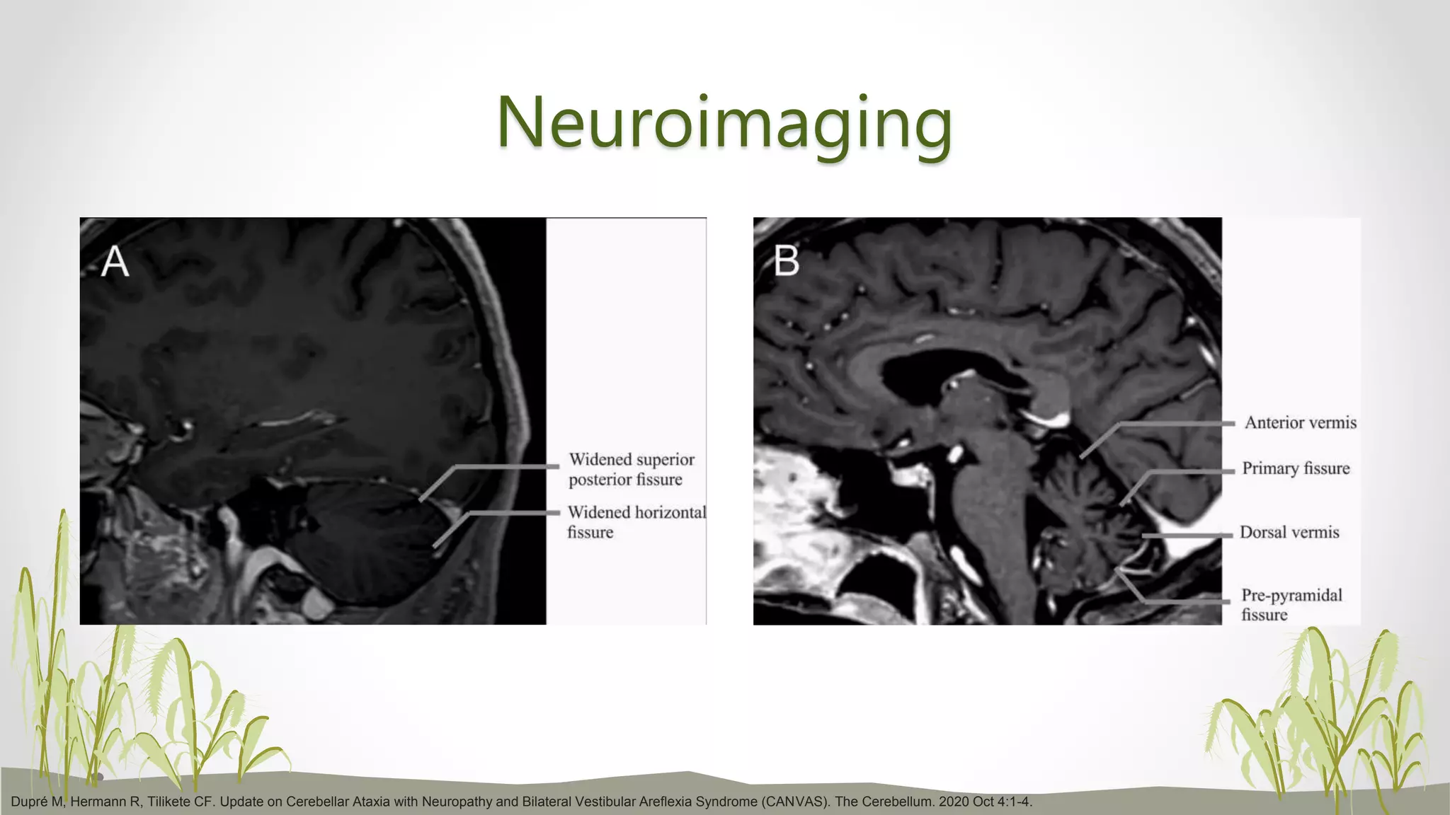 Cerebellar Ataxia with Neuropathy and Bilateral Vestibular Areflexia ...