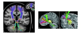 cerebellar mutism SIGNS SYMPTOMS AND MANAGEMENT | PPTX
