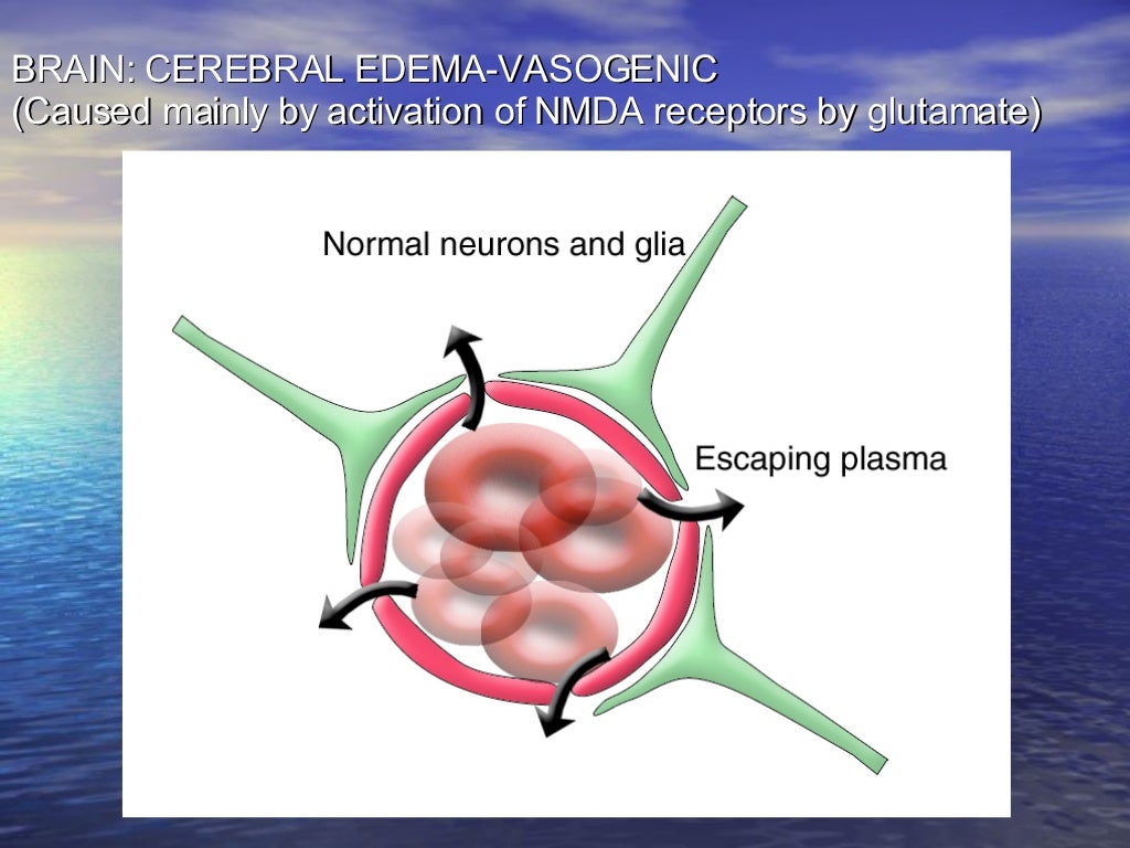Cerebral Edema