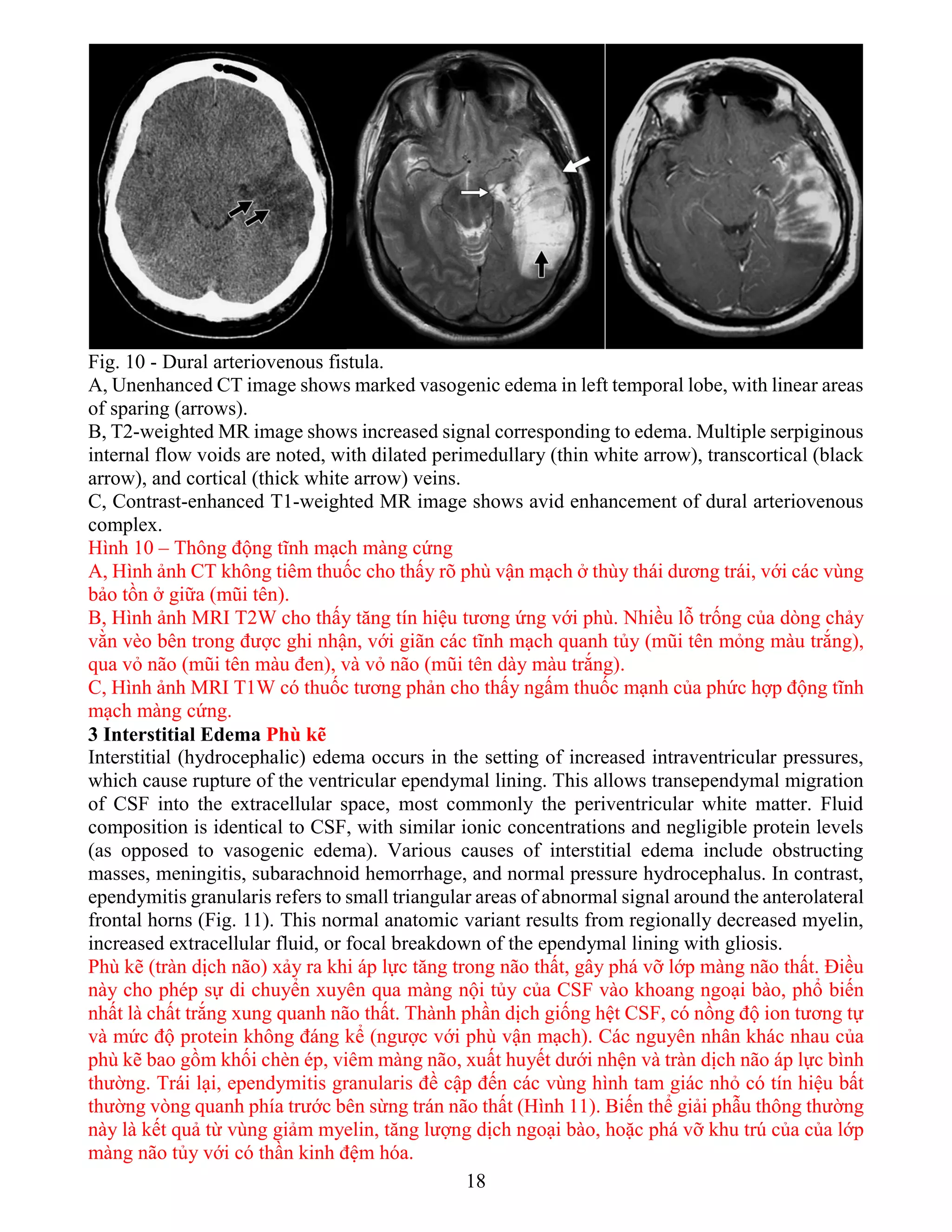Cerebral-Edema-Phu-nao.pdf