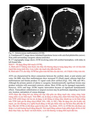 Cerebral-Edema-Phu-nao.pdf