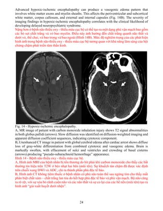 Cerebral-Edema-Phu-nao.pdf