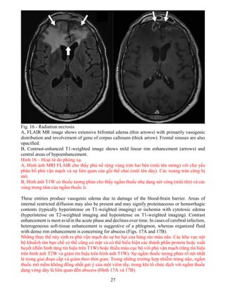 Cerebral-Edema-Phu-nao.pdf