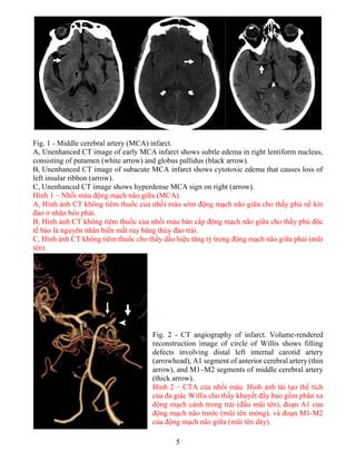 Cerebral-Edema-Phu-nao.pdf
