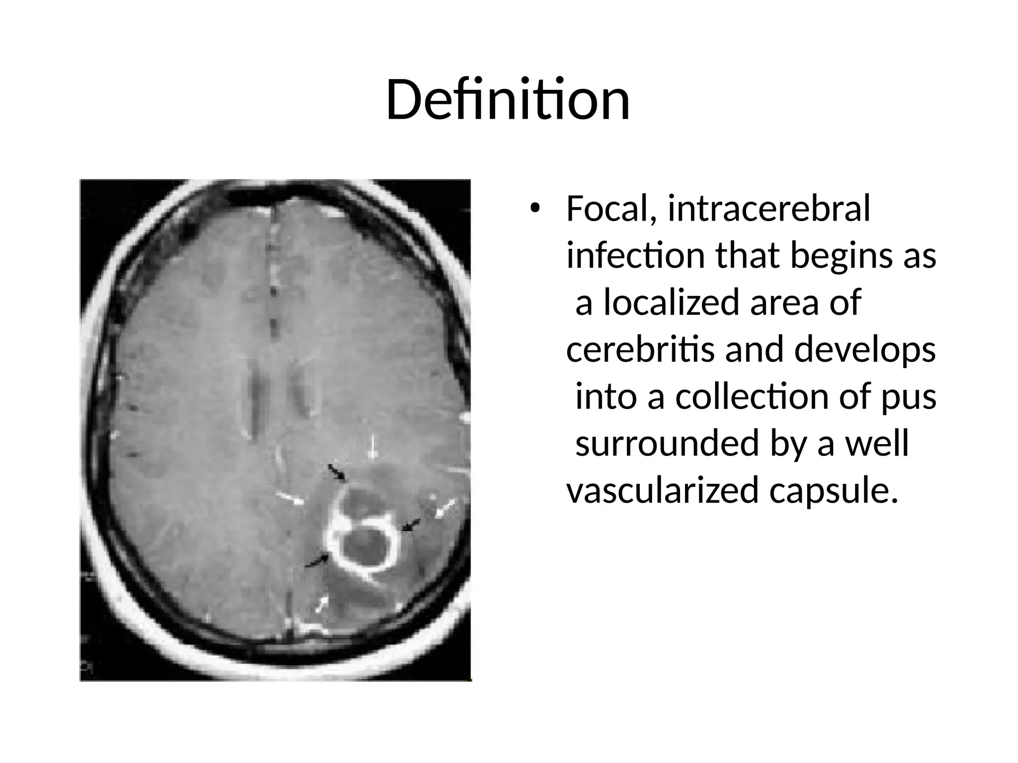 Cerebral Abscess DVDFZVBSDBGDFNDFNDFGNDFNDFG | PPTX