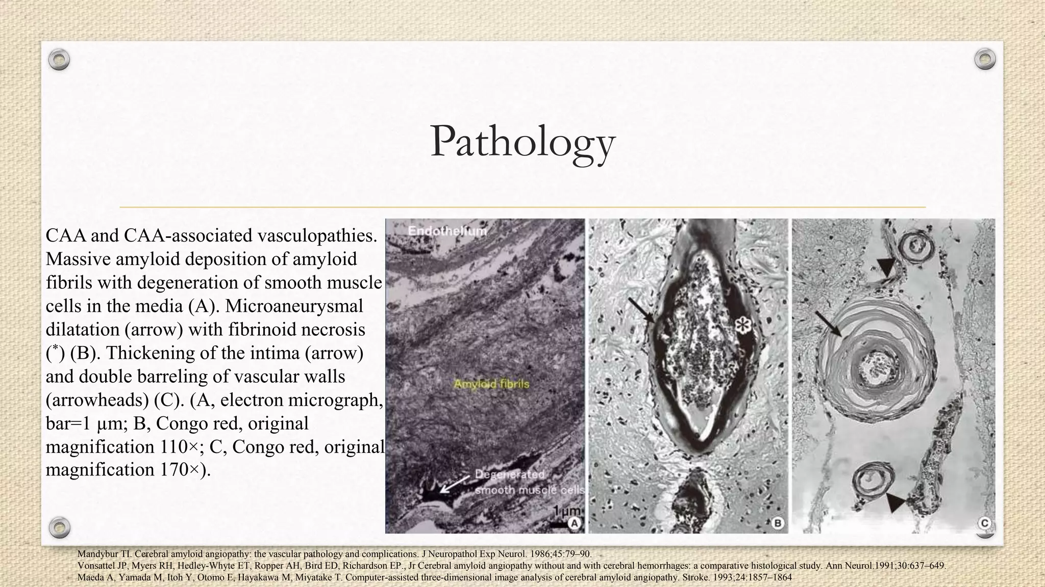 Cerebral Amyloid Angiopathy | PPTX