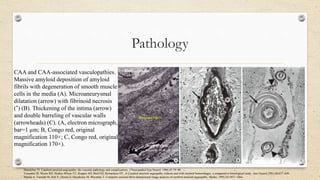 Cerebral Amyloid Angiopathy | PPTX