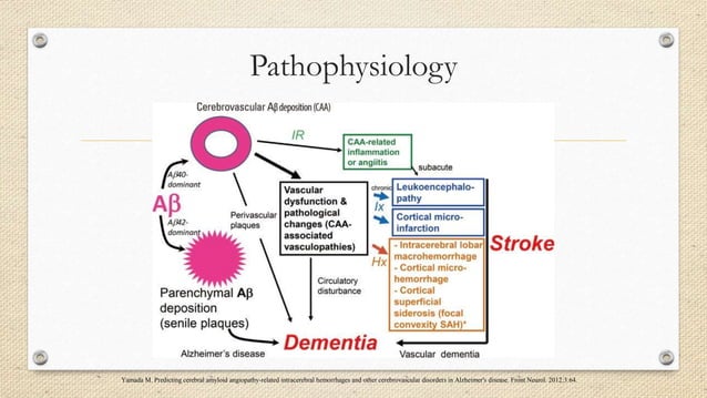 Cerebral Amyloid Angiopathy | PPTX