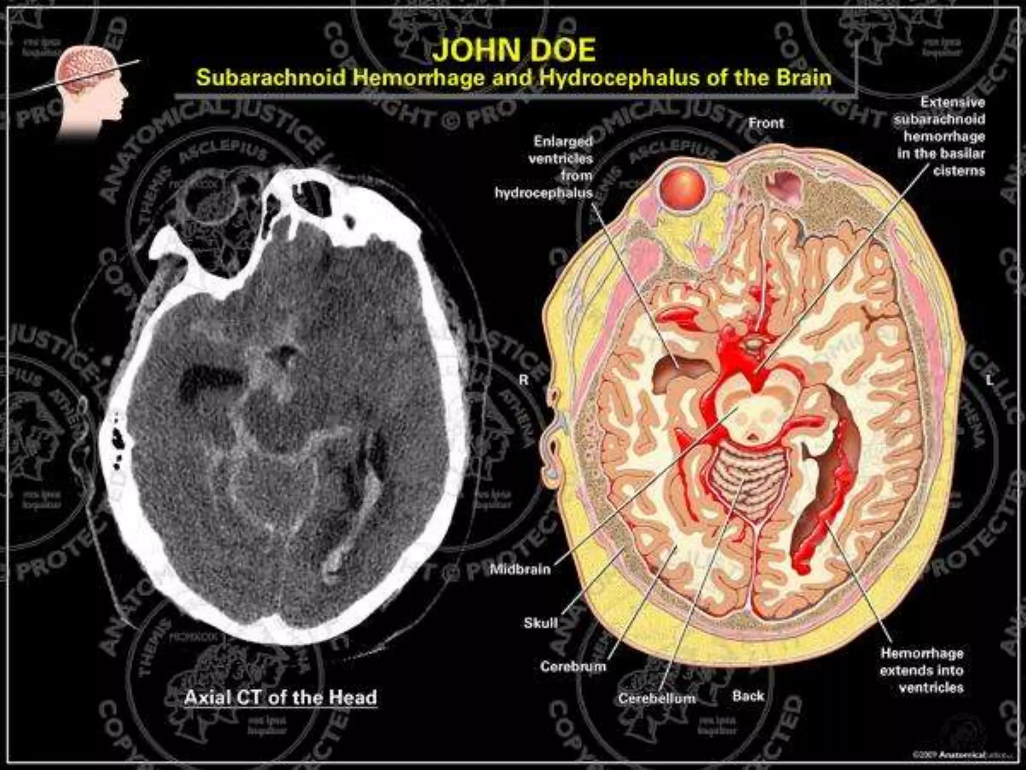 Cerebral Aneursym & Subarachnoid Haemorrhage | PPT