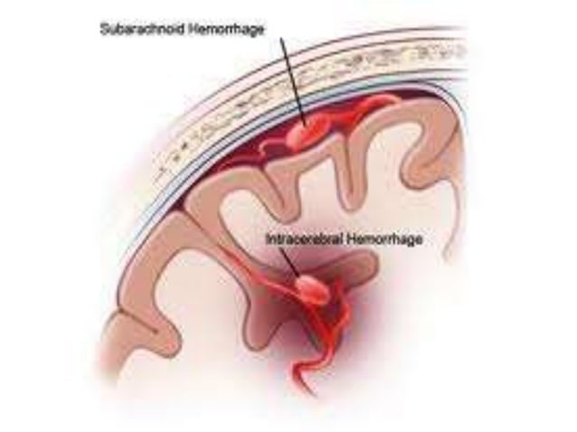 Cerebral Aneursym & Subarachnoid Haemorrhage | PPT