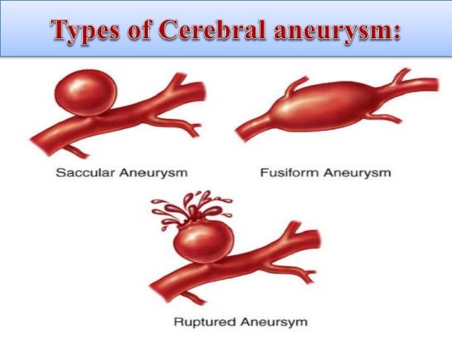 Cerebral aneurysm