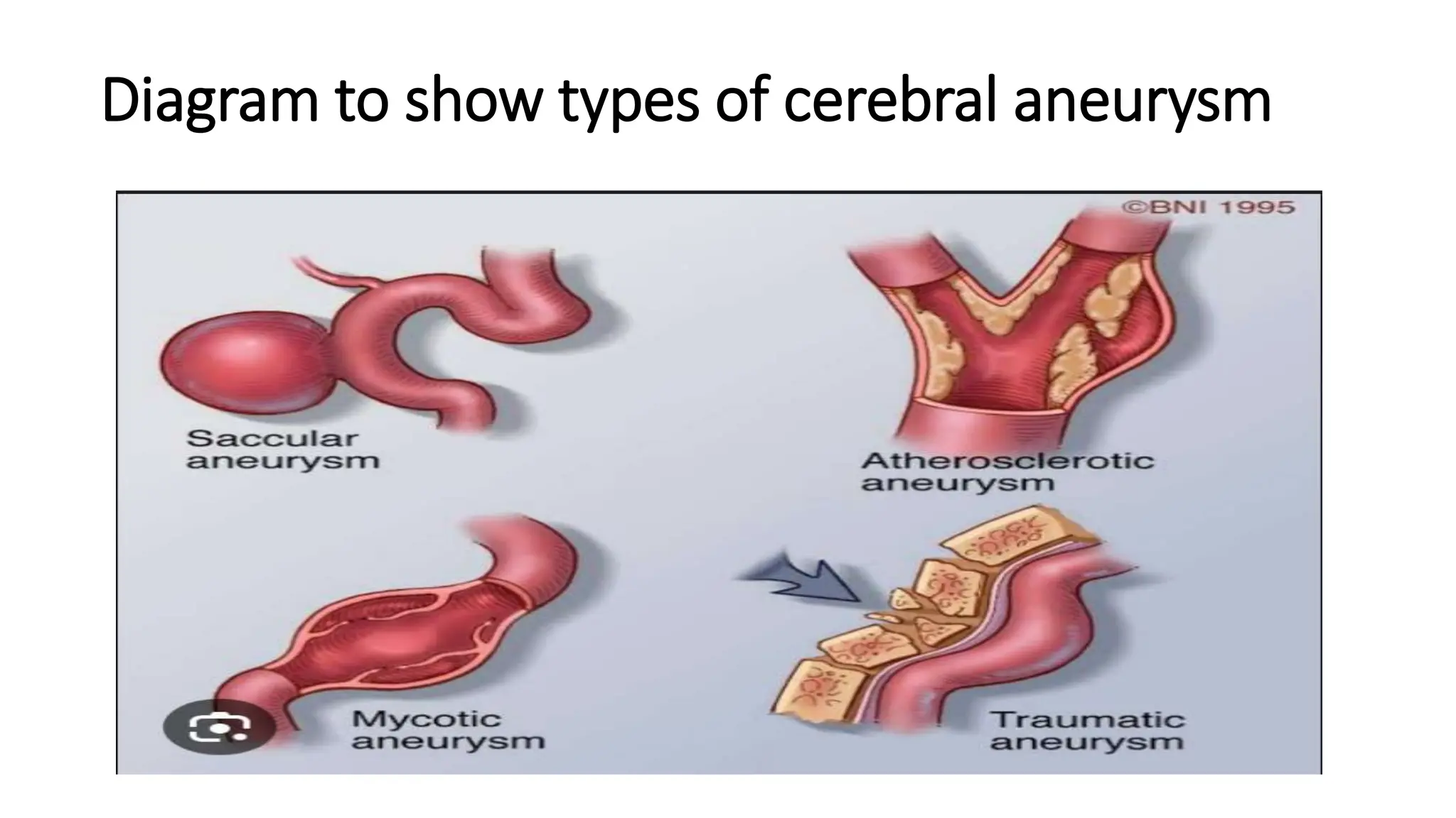 CEREBRAL ANEURYSM .pptx