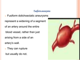 Aneurysms | PPTX