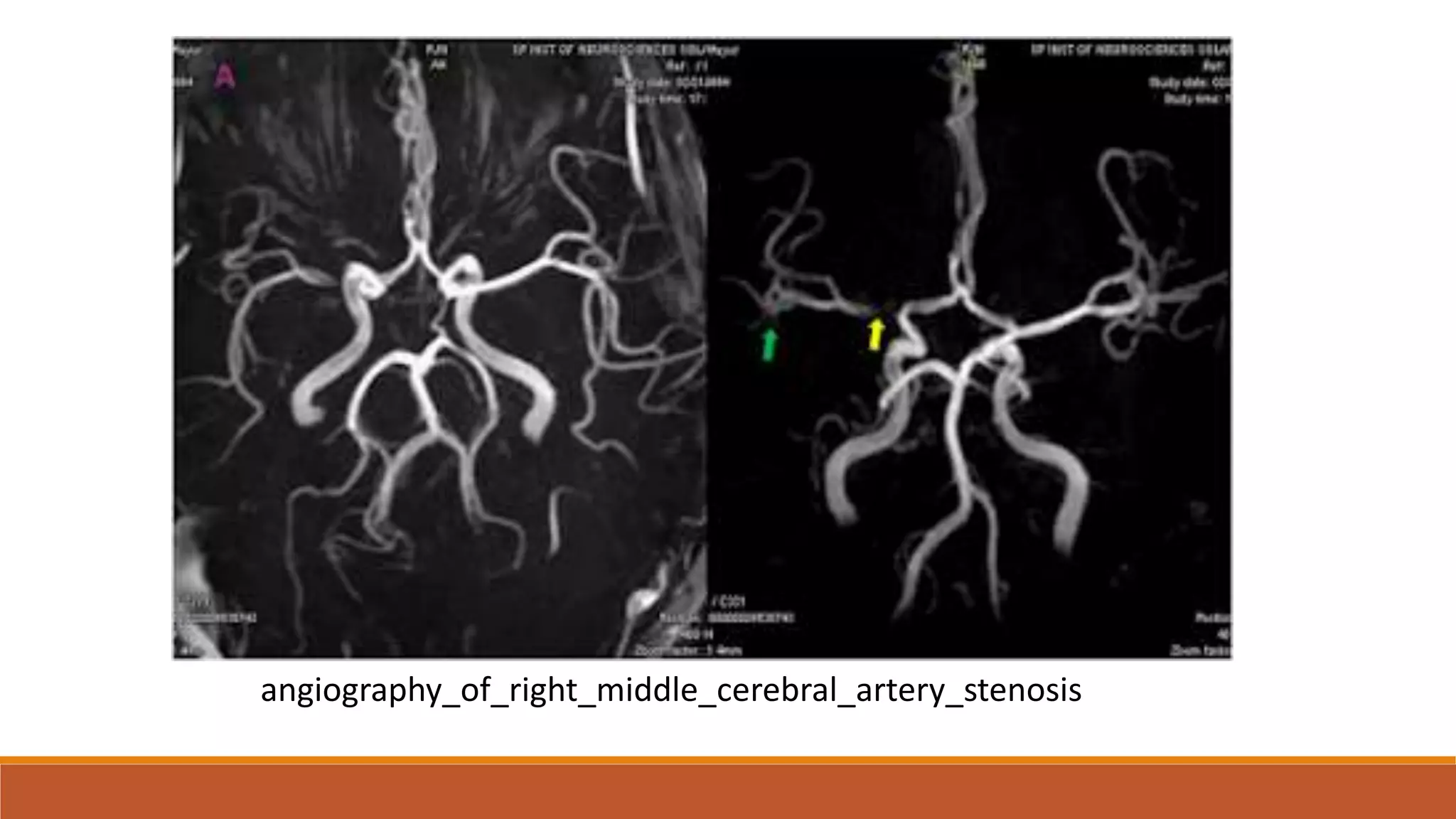 Cerebral angiography - medical information | PPTX