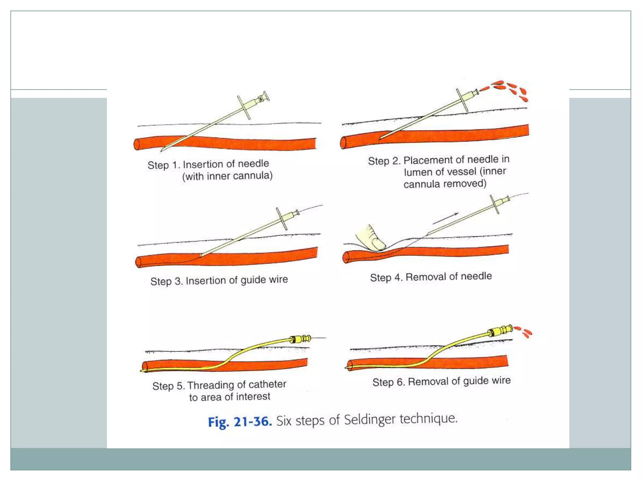 Cerebral angiography procedure | PPTX