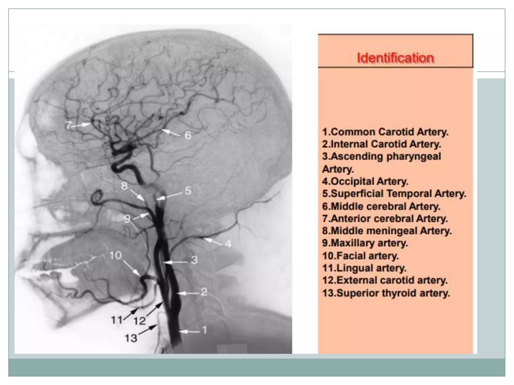 Cerebral angiography procedure | PPTX