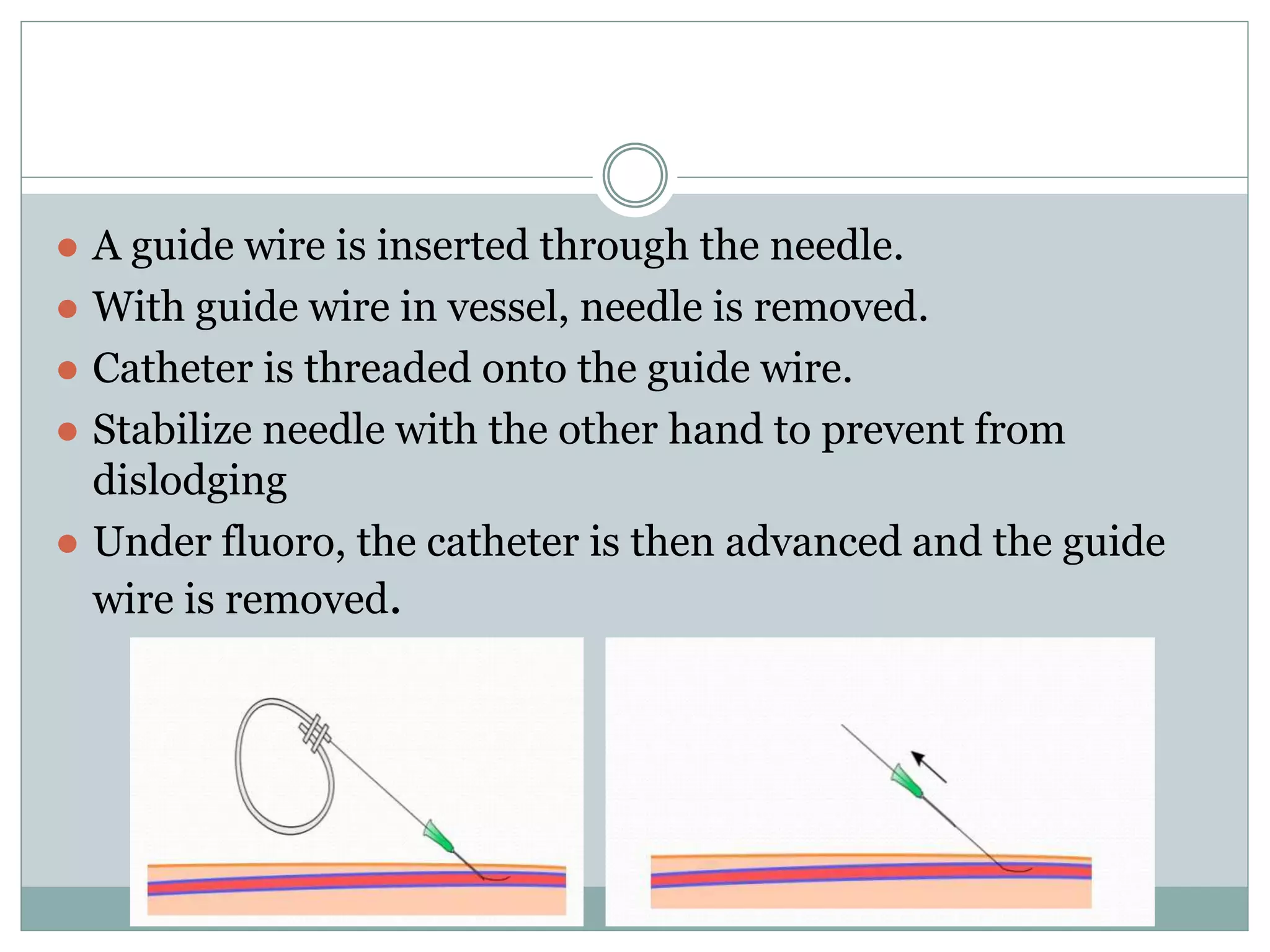 Cerebral angiography procedure | PPTX