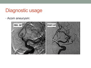 Cerebral angiography technique | PPTX