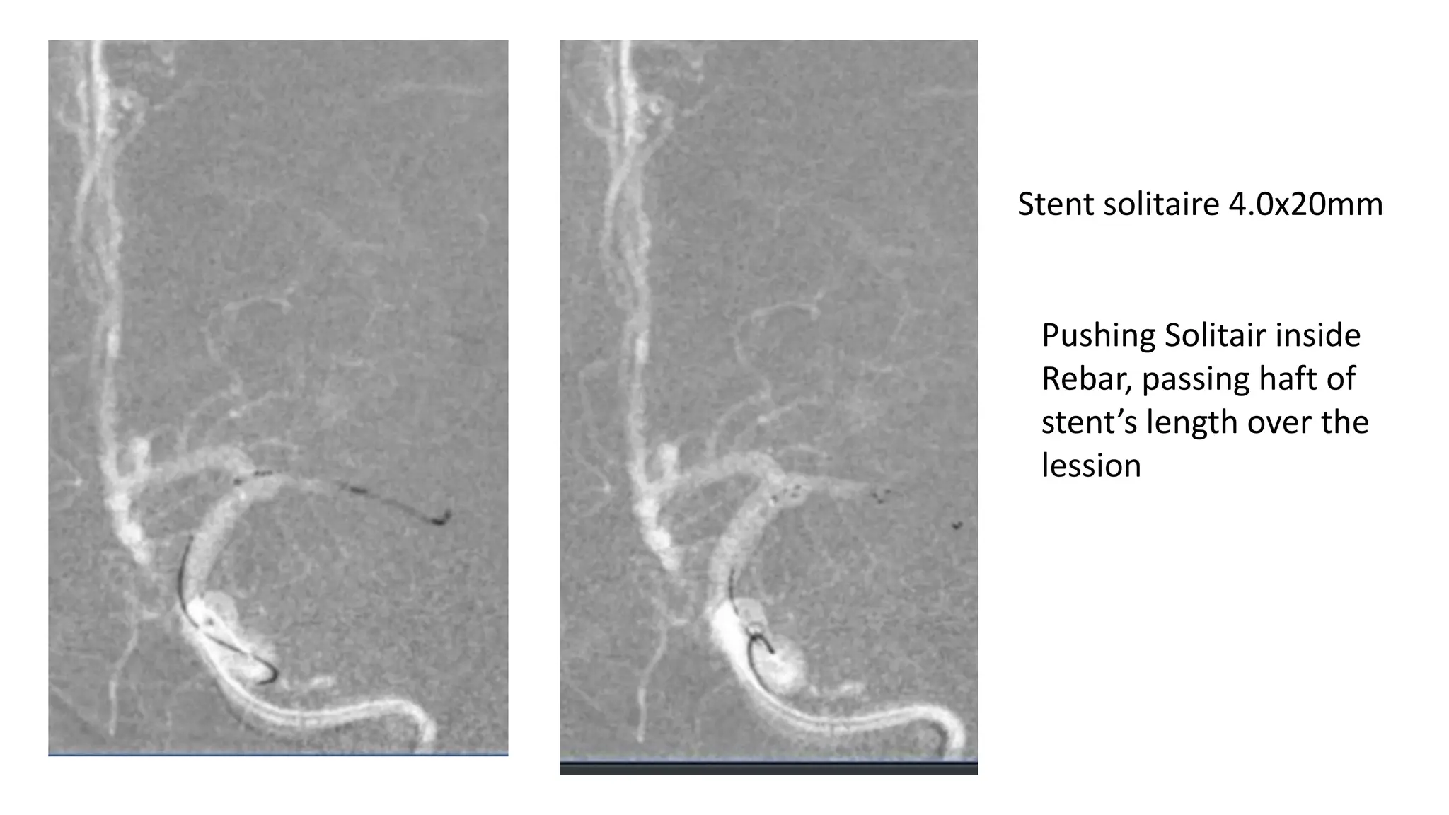 CEREBRAL ANGIOPLASTY IN ACUTE ISCHEMIC STROKE | PPTX