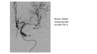 CEREBRAL ANGIOPLASTY IN ACUTE ISCHEMIC STROKE | PPTX