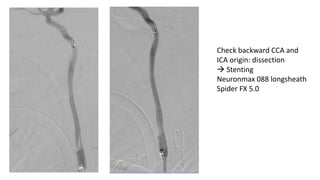 CEREBRAL ANGIOPLASTY IN ACUTE ISCHEMIC STROKE | PPTX