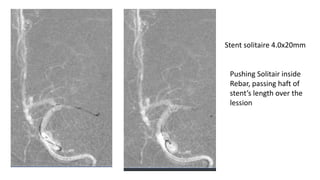 CEREBRAL ANGIOPLASTY IN ACUTE ISCHEMIC STROKE | PPTX