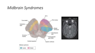 Cerebral circulation and brain stem syndromes | PPTX