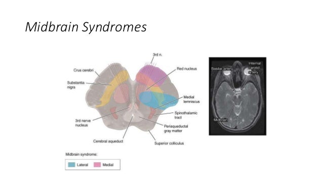 Cerebral circulation and brain stem syndromes