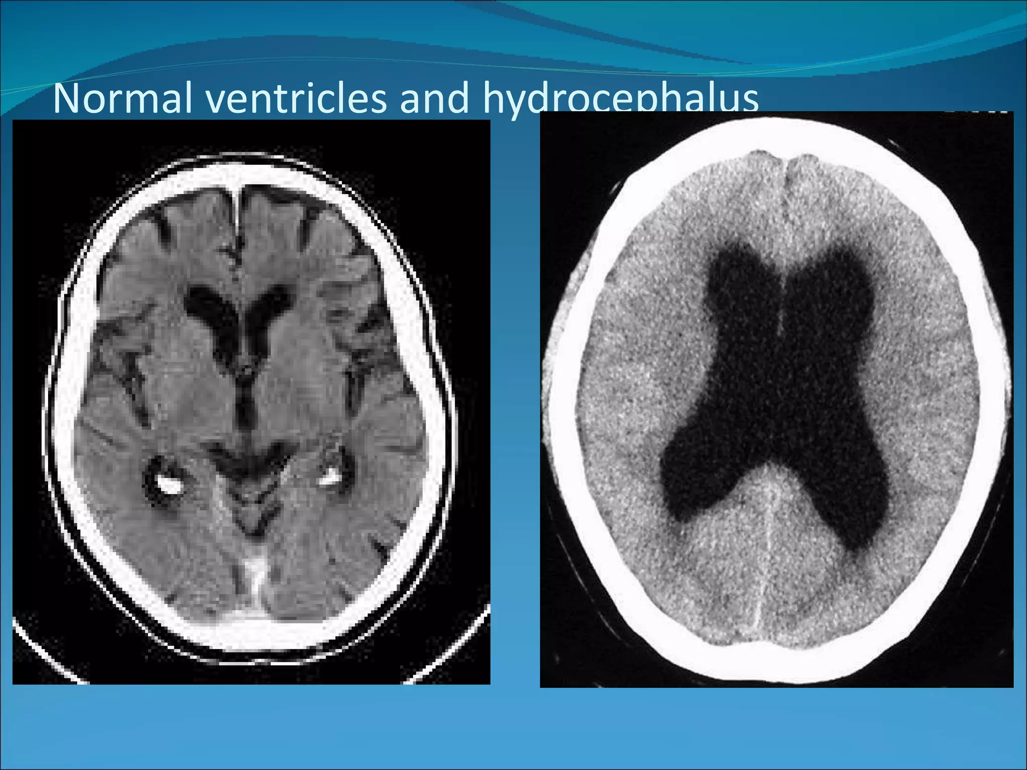 Cerebral circulation & csf formation | PPT