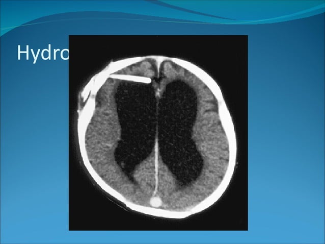 Cerebral circulation & csf formation | PPT