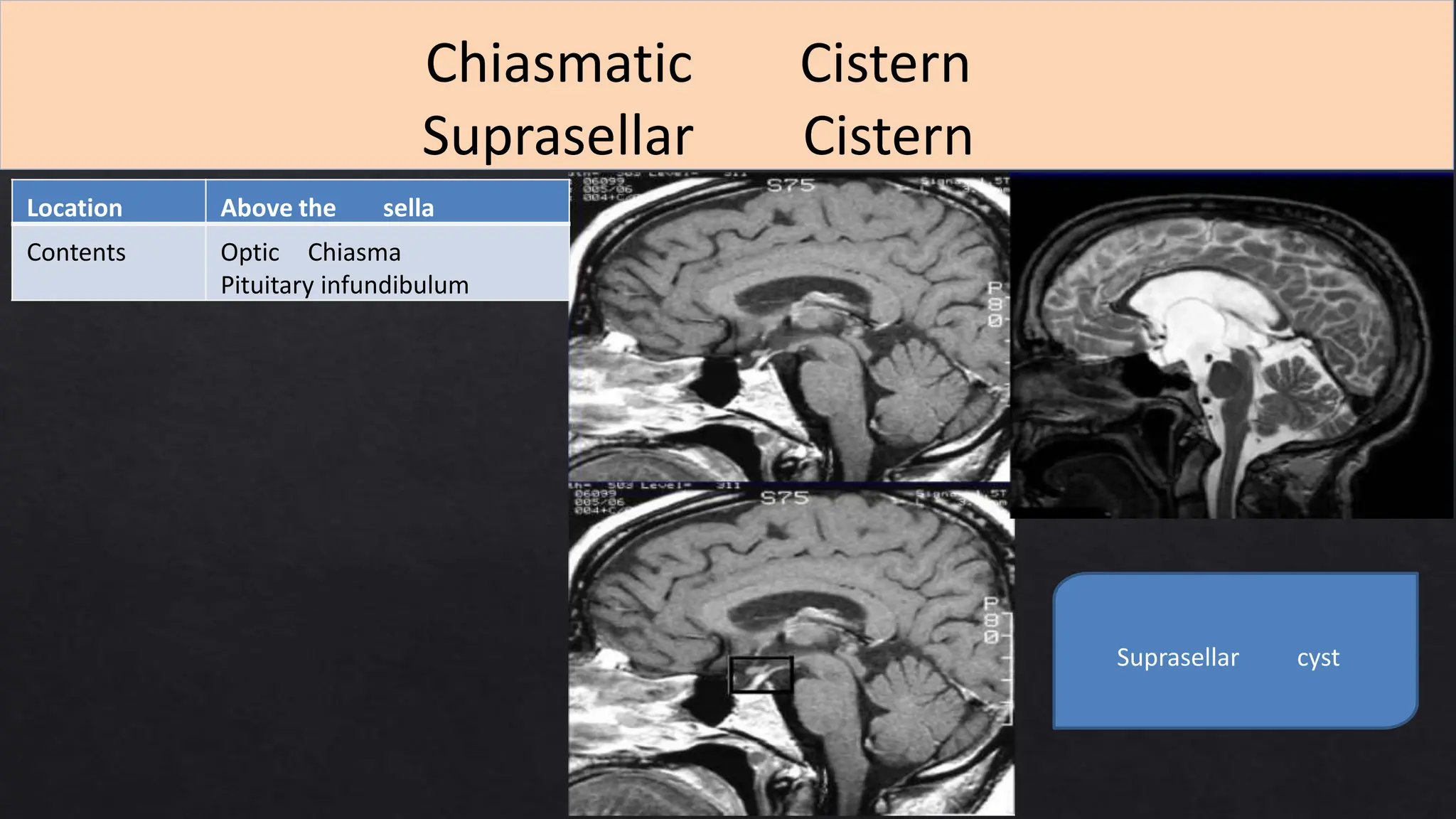 cerebral cisterns for radiology dnb .pptx
