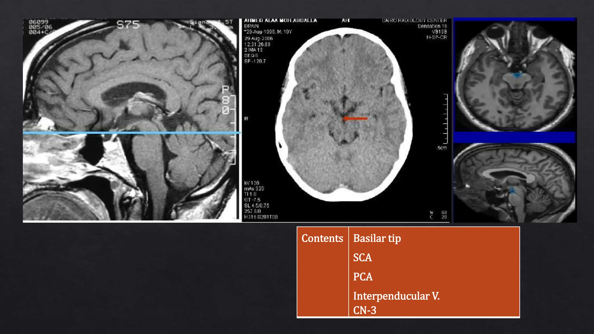 cerebral cisterns for radiology dnb .pptx