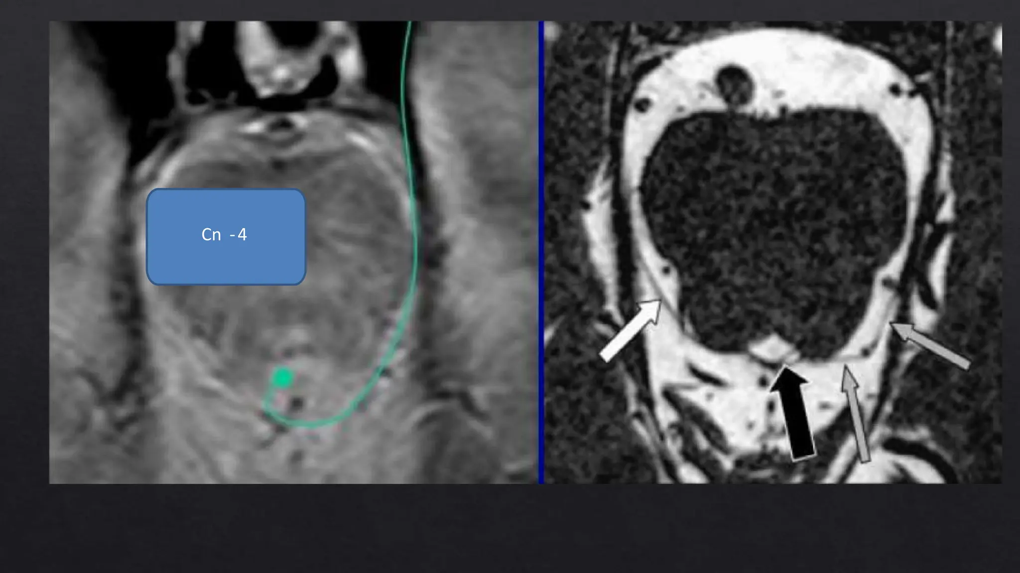 cerebral cisterns for radiology dnb .pptx