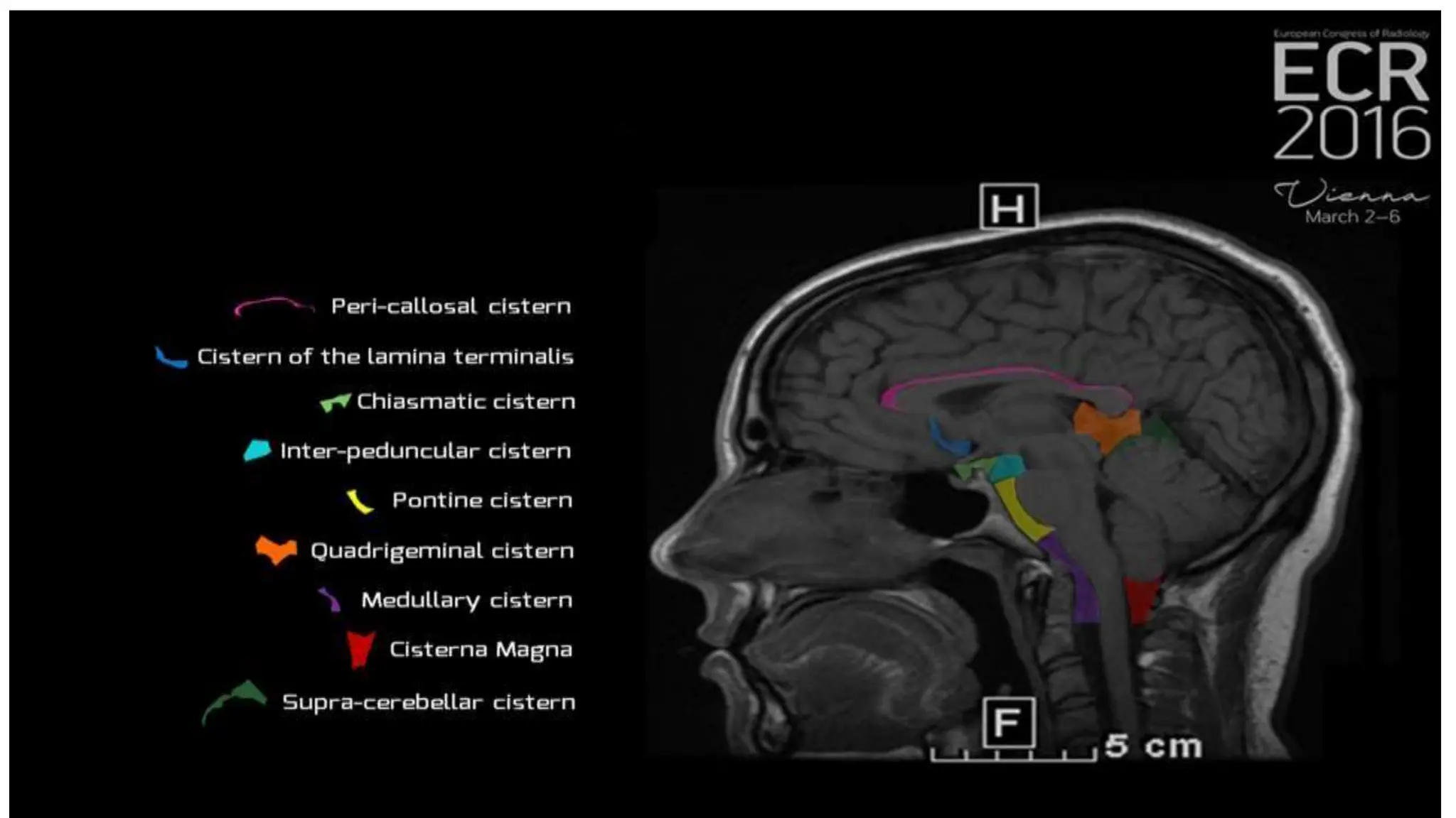 cerebral cisterns for radiology dnb .pptx