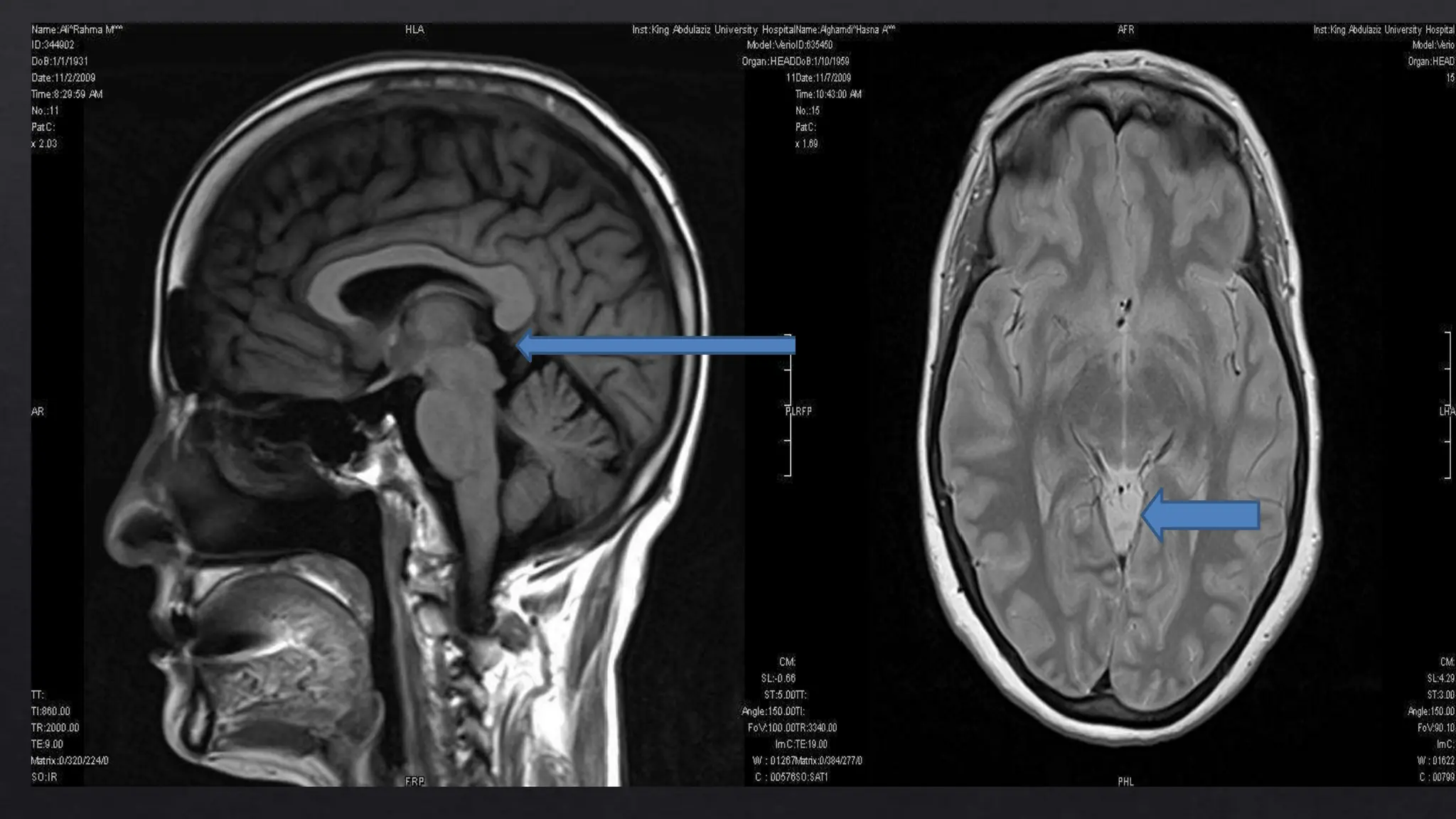 cerebral cisterns for radiology dnb .pptx