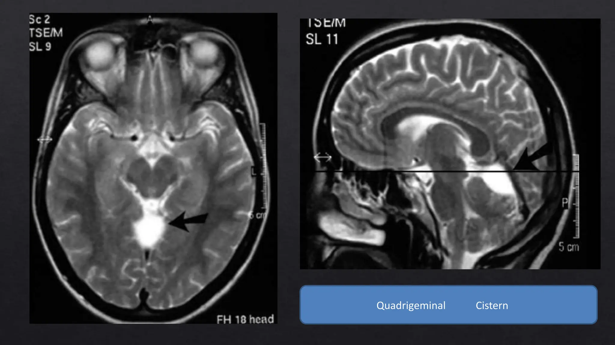 cerebral cisterns for radiology dnb .pptx