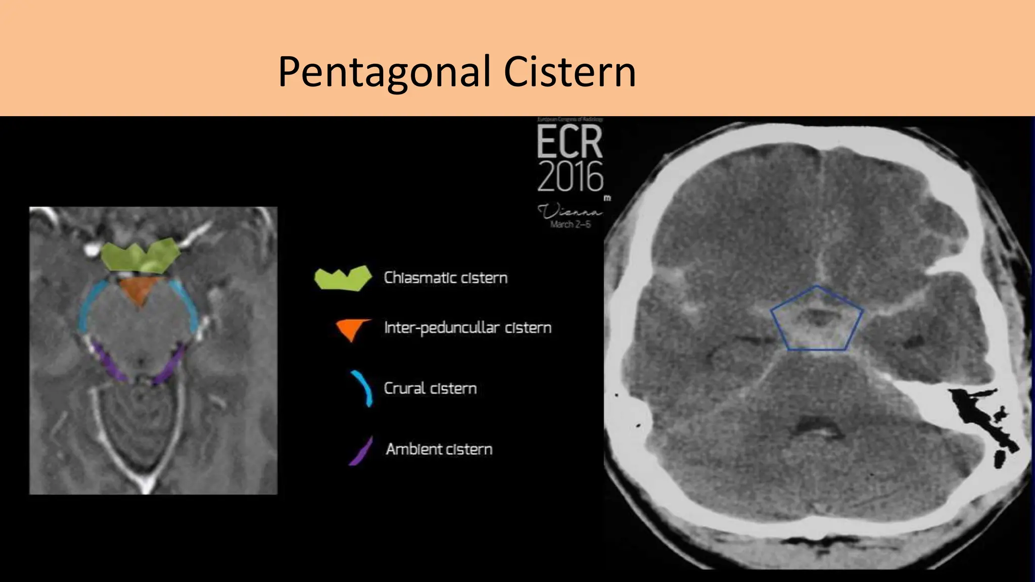 cerebral cisterns for radiology dnb .pptx