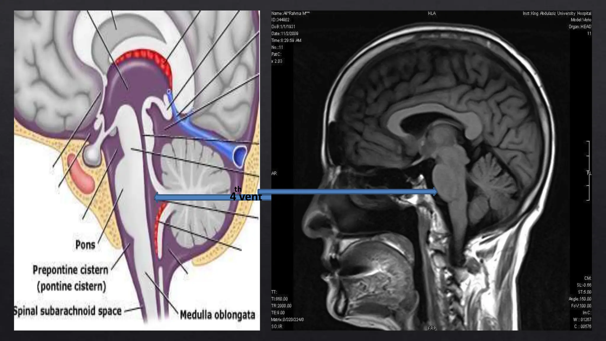 cerebral cisterns for radiology dnb .pptx