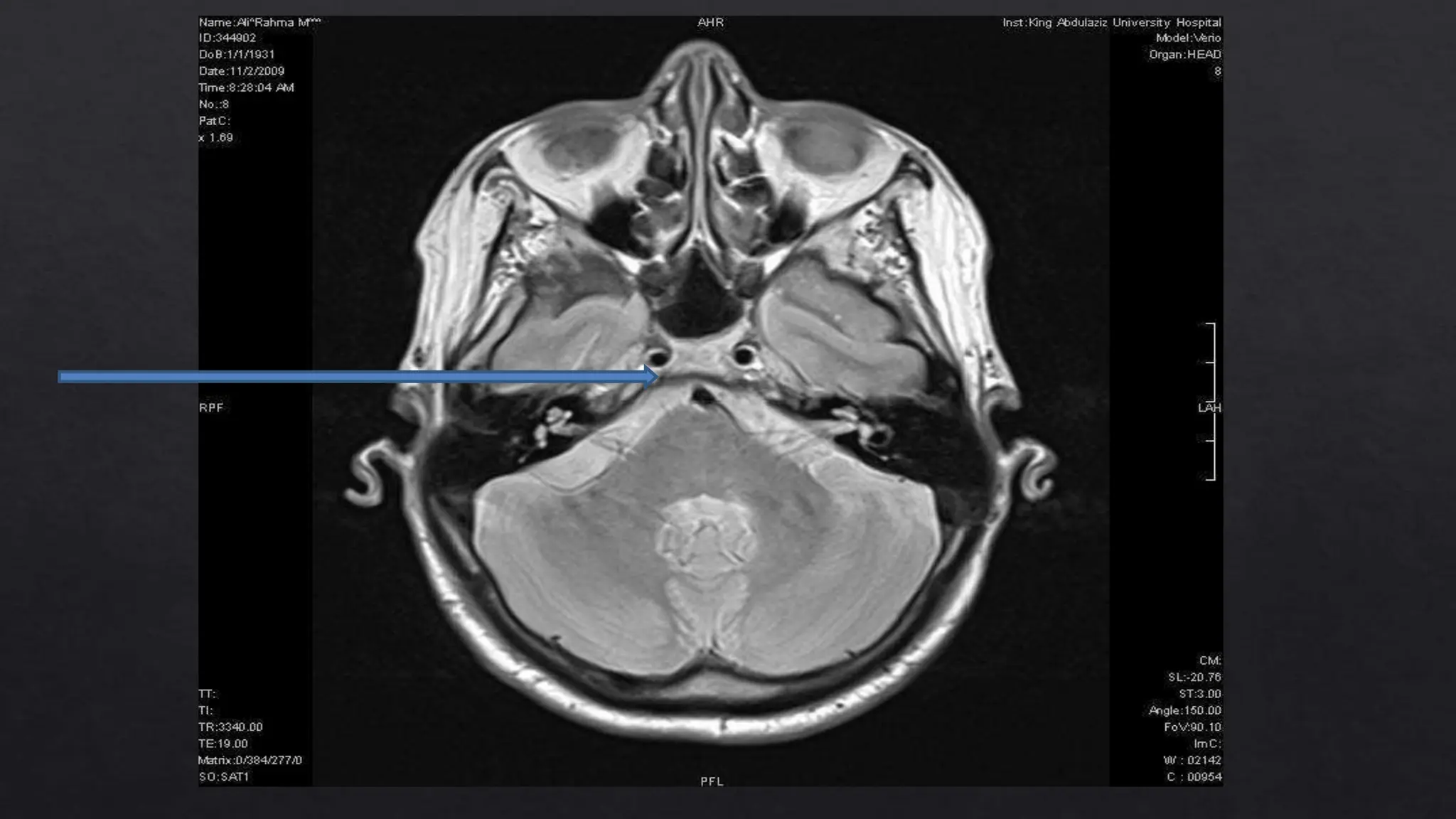 cerebral cisterns for radiology dnb .pptx