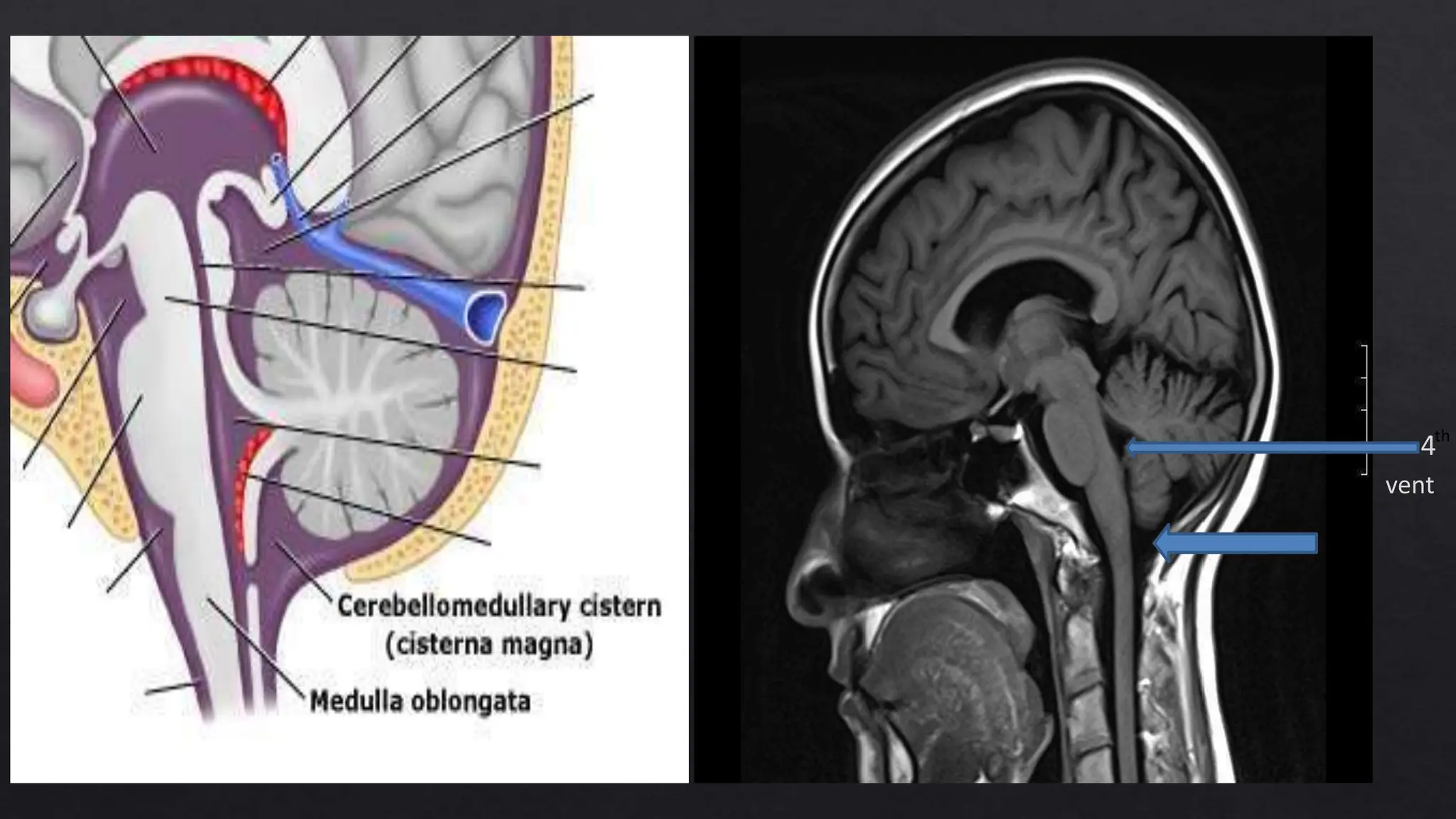 cerebral cisterns for radiology dnb .pptx