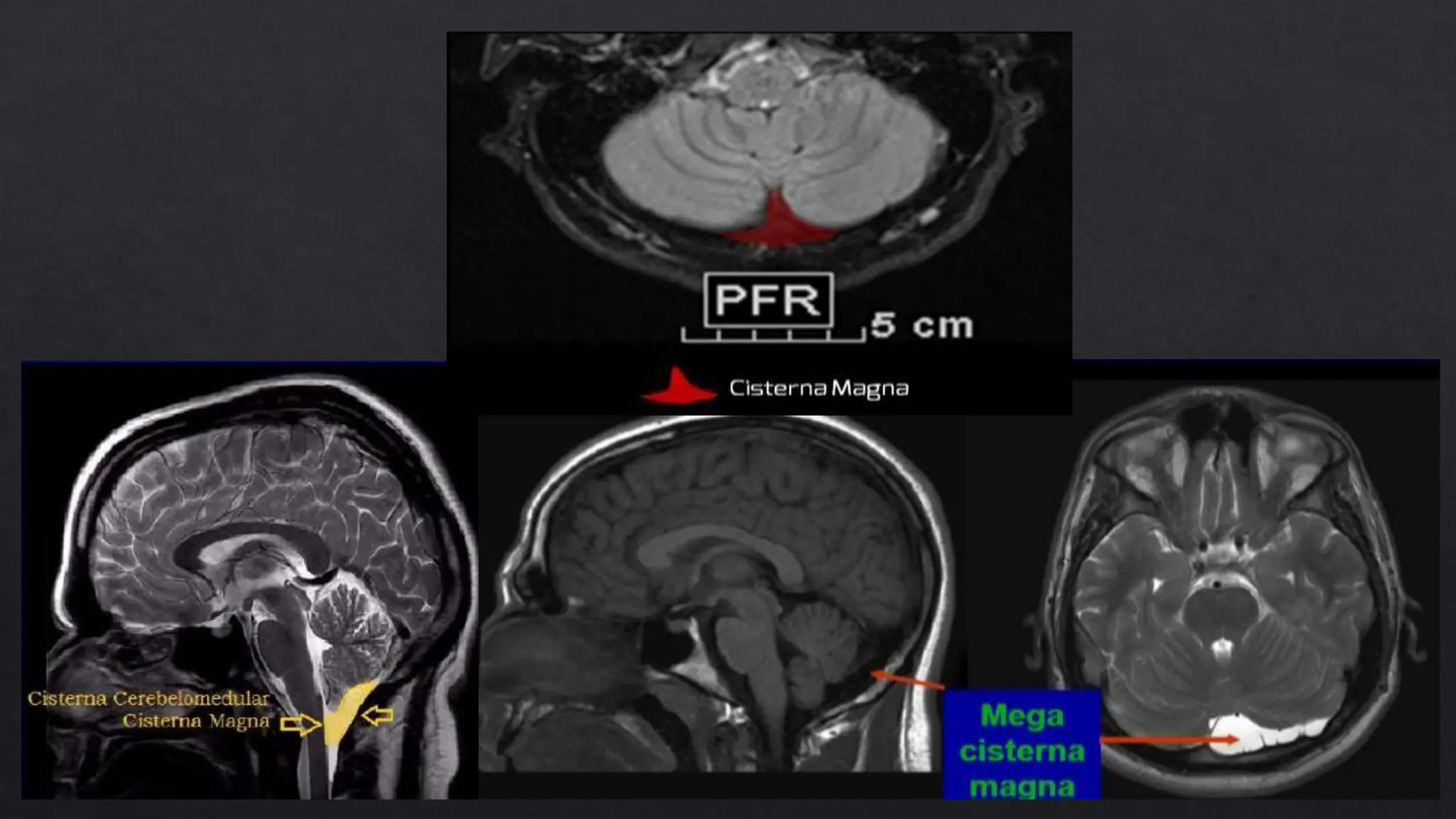 cerebral cisterns for radiology dnb .pptx