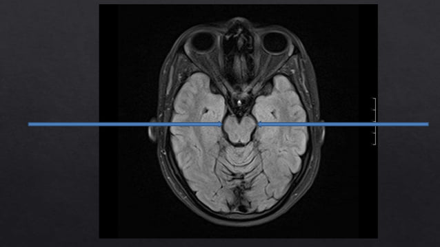 cerebral cisterns for radiology dnb .pptx