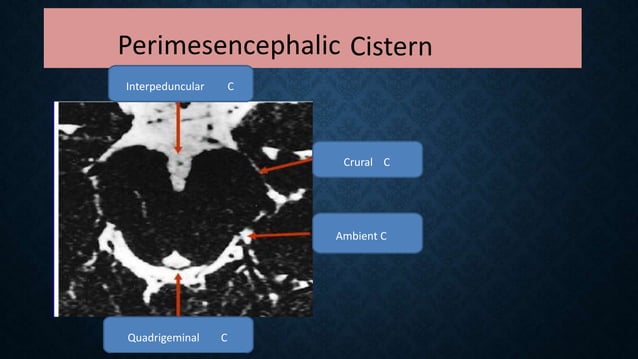 cerebral cisterns for radiology dnb .pptx