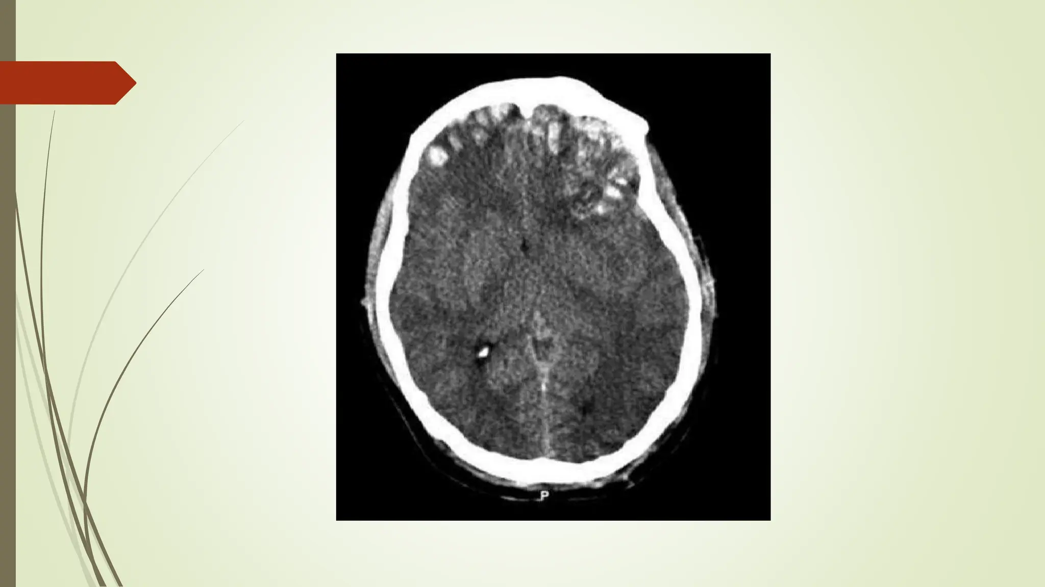 CEREBRAL CONTUSION Presentation Slide share | PPTX