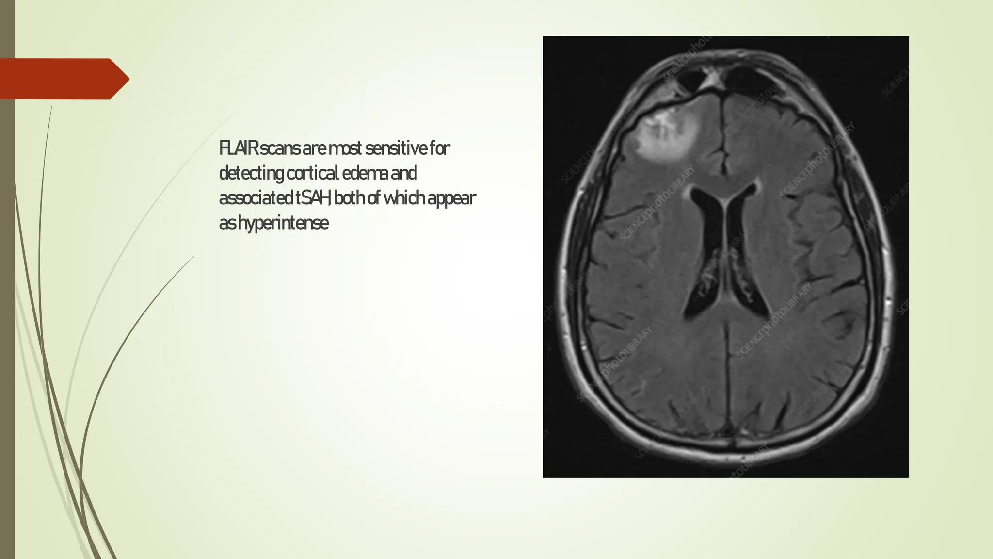 CEREBRAL CONTUSION Presentation Slide share | PPTX